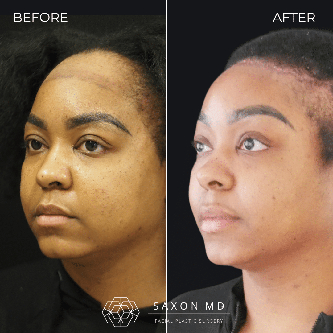 Forehead Reduction Surgery Before And After