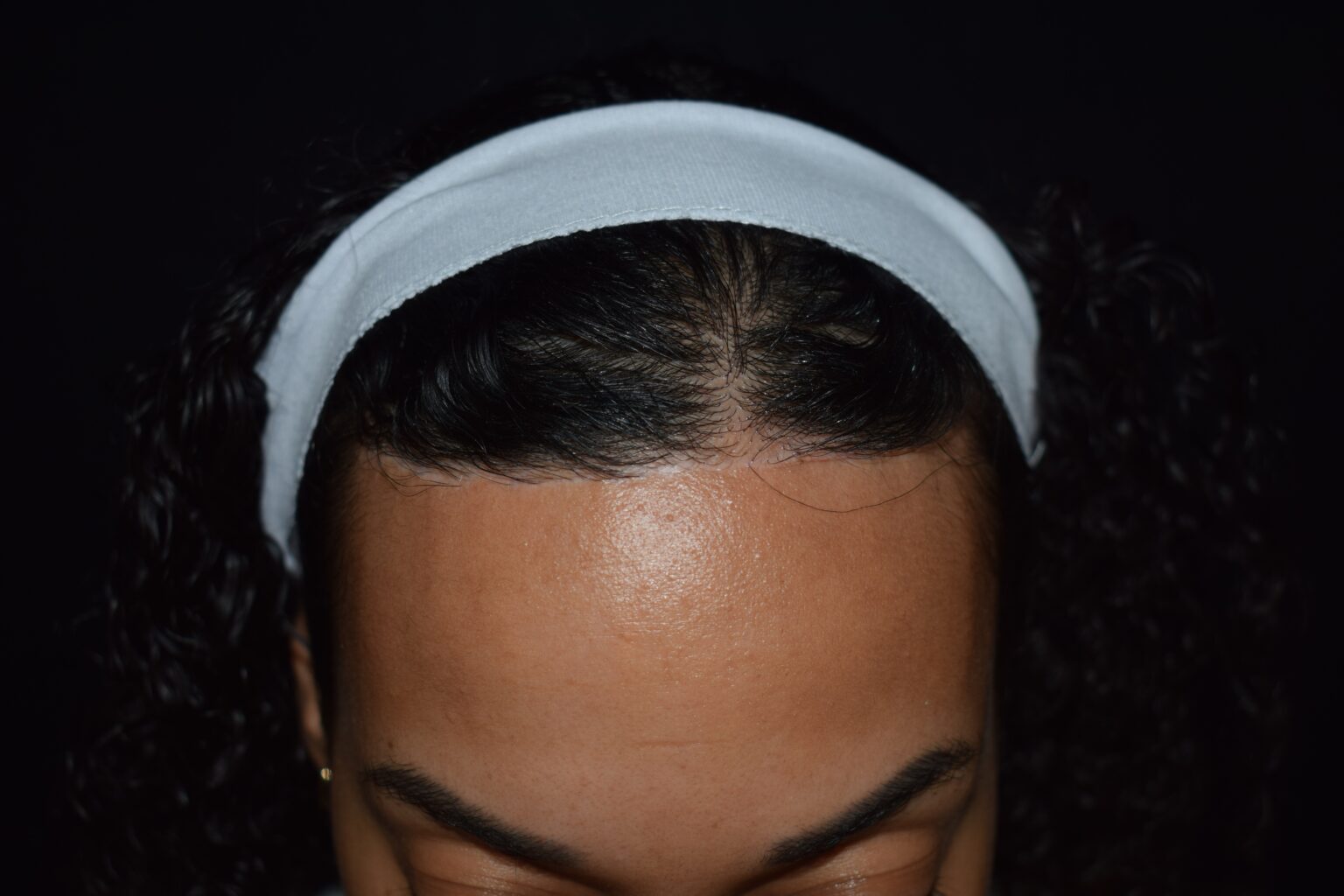 Understanding Shock Hair Loss: Causes & Management