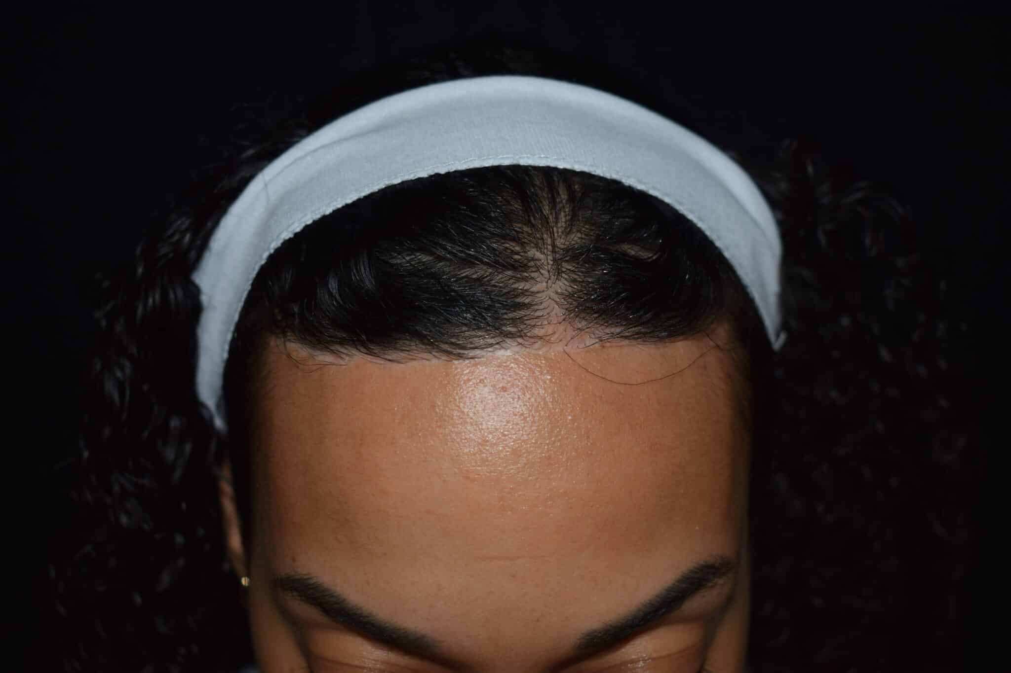 Understanding Shock Hair Loss: Causes & Management