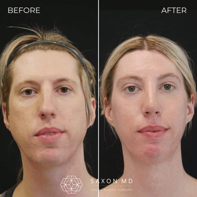 Facial Feminization Surgery Before And After Photos | FFS Austin & Dallas, TX