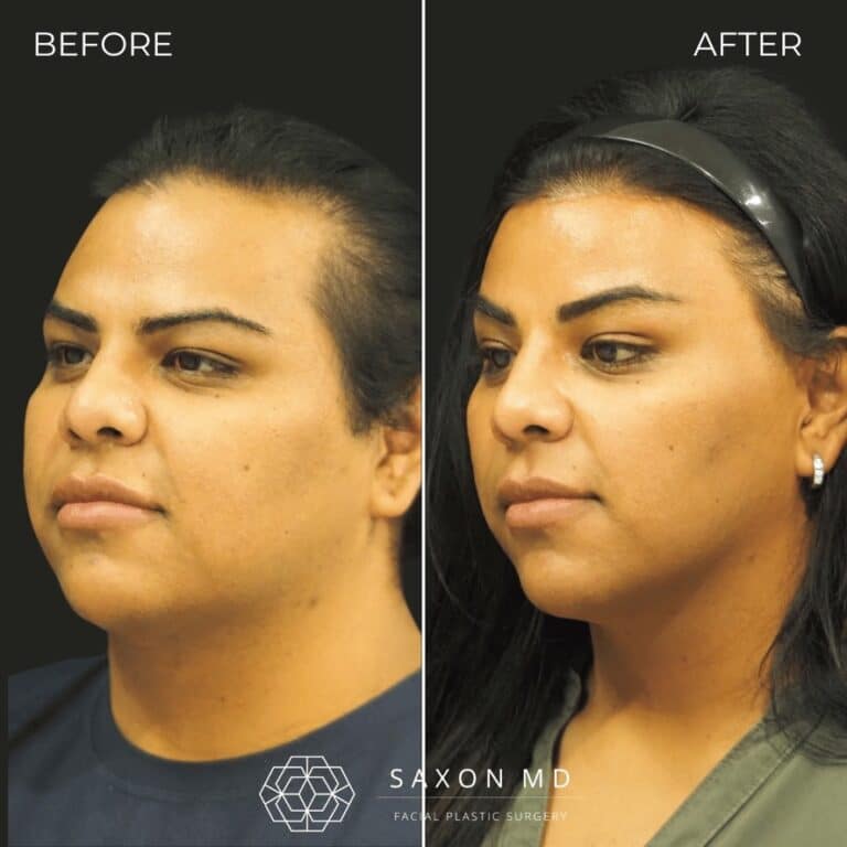 Facial Feminization Surgery Before And After Photos | FFS Austin ...