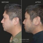 Deep Plane Facelift Austin | Facelift Austin | Facelift Dallas