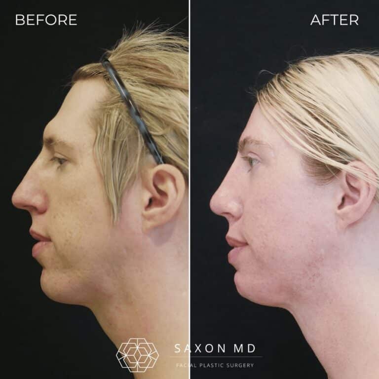 Facial Feminization Surgery Before And After Photos | FFS Austin ...