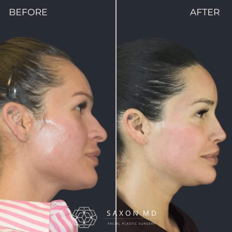 Facial Feminization Surgery Before And After Photos | FFS Austin ...