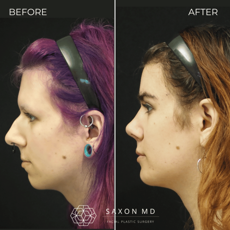 Facial Feminization Surgery Before And After Photos | FFS Austin ...