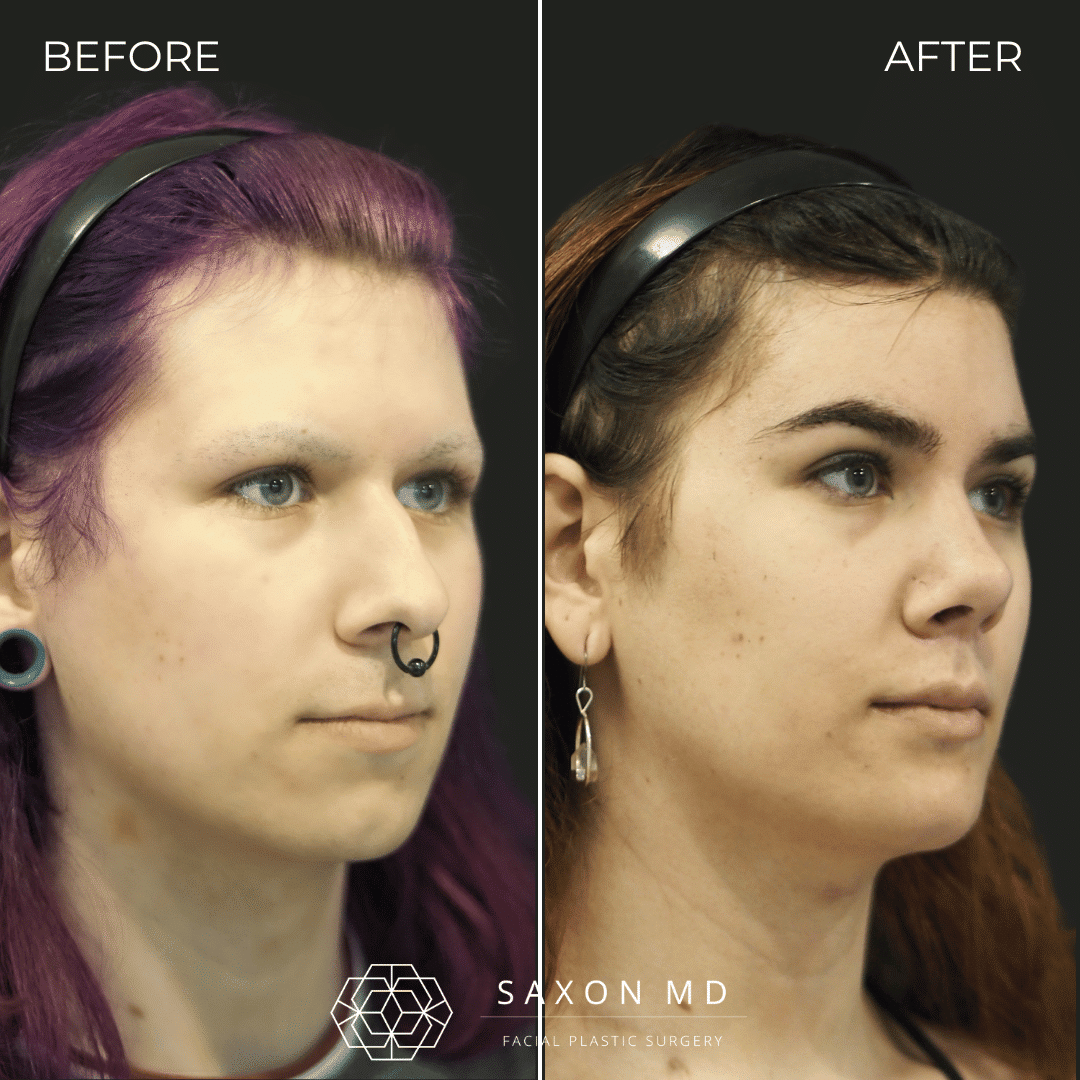 Facial Feminization Surgery Before And After Photos | FFS Austin ...