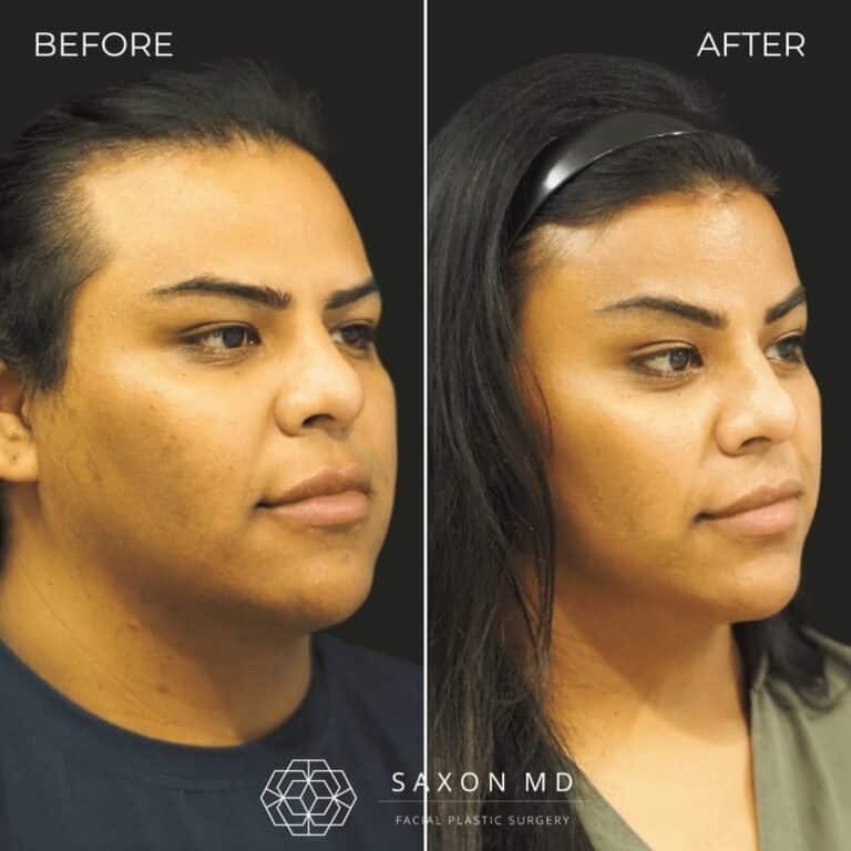 Facial Feminization Surgery Before And After Photos | FFS Austin ...