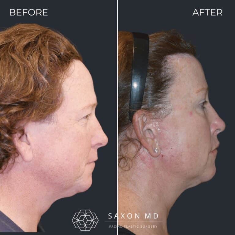Facial Feminization Surgery Before And After Photos | FFS Austin ...