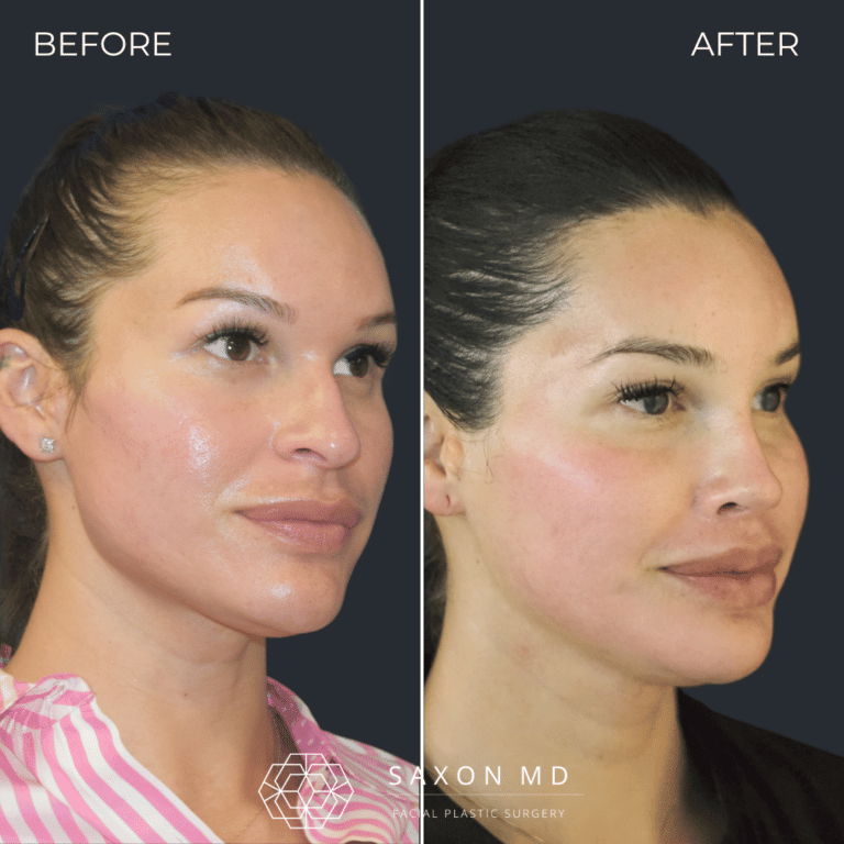 Facial Feminization Surgery Before And After Photos | FFS Austin ...