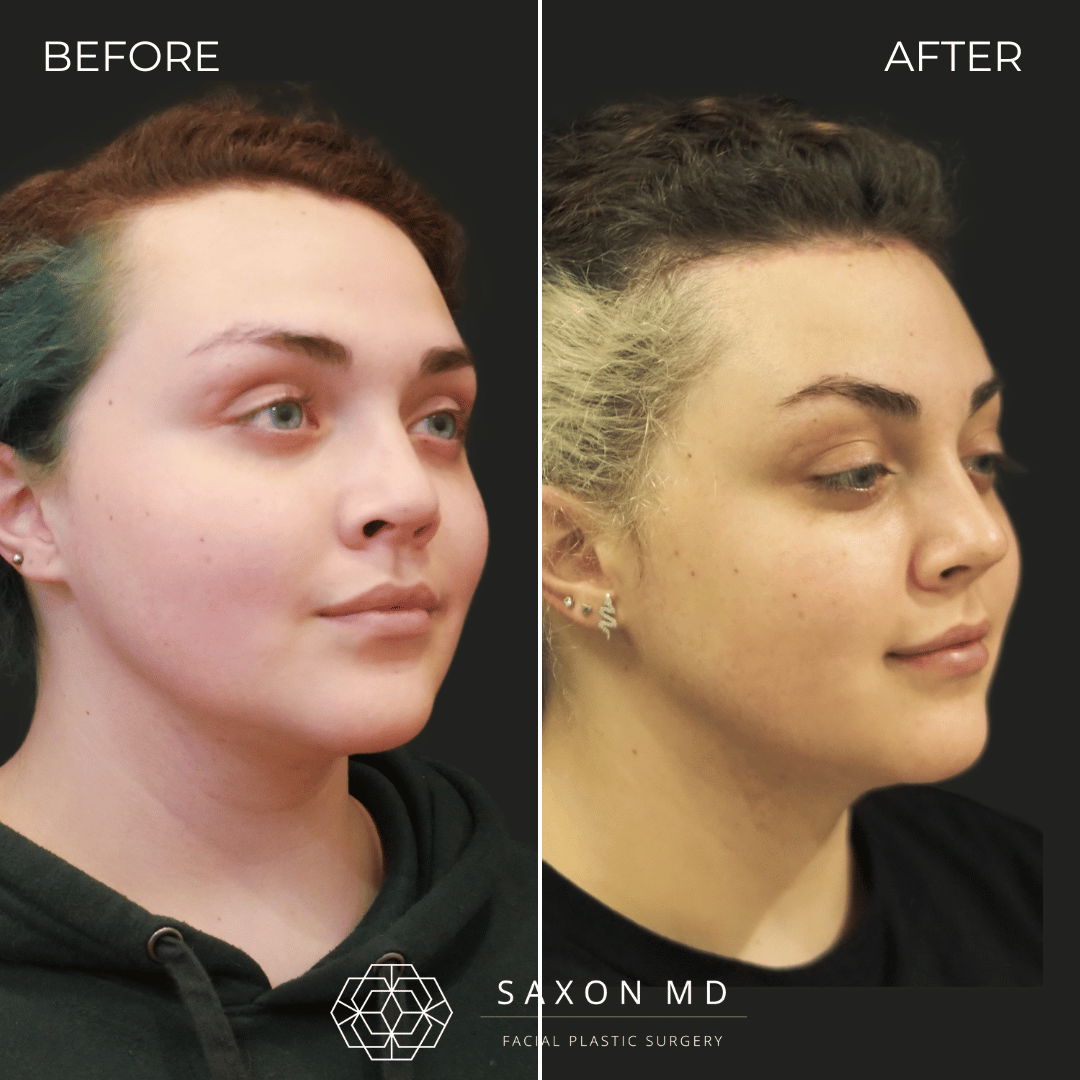 Brow Bone Reduction Before And After | Austin & Dallas, TX