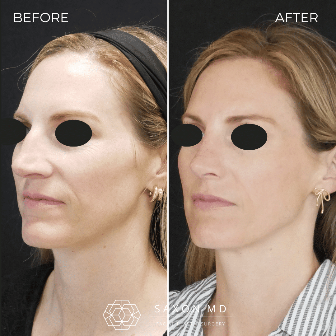 Nose Job Recovery Time: What To Expect After Rhinoplasty
