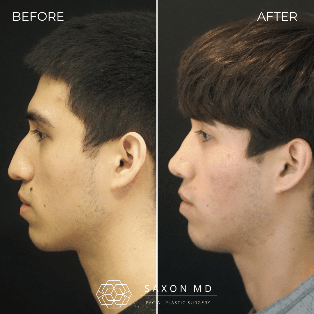 Top Surgical Procedures That Can Redefine Your Side Profile