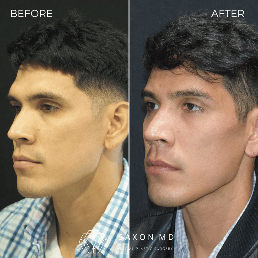 Brow Bone Reduction Before And After | Austin & Dallas, TX