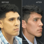 Brow Bone Reduction Before And After | Austin & Dallas, TX