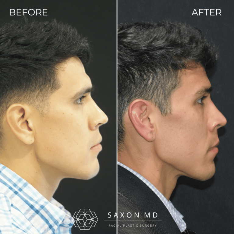 Brow Bone Reduction | Cranioplasty | Austin & Dallas, TX