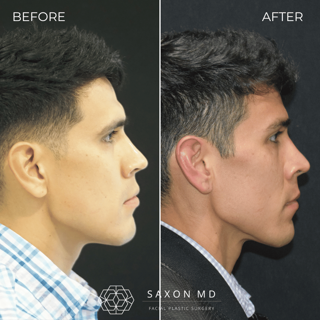 Brow Bone Reduction | Cranioplasty | Austin & Dallas, TX