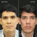 Brow Bone Reduction Before And After | Austin & Dallas, TX