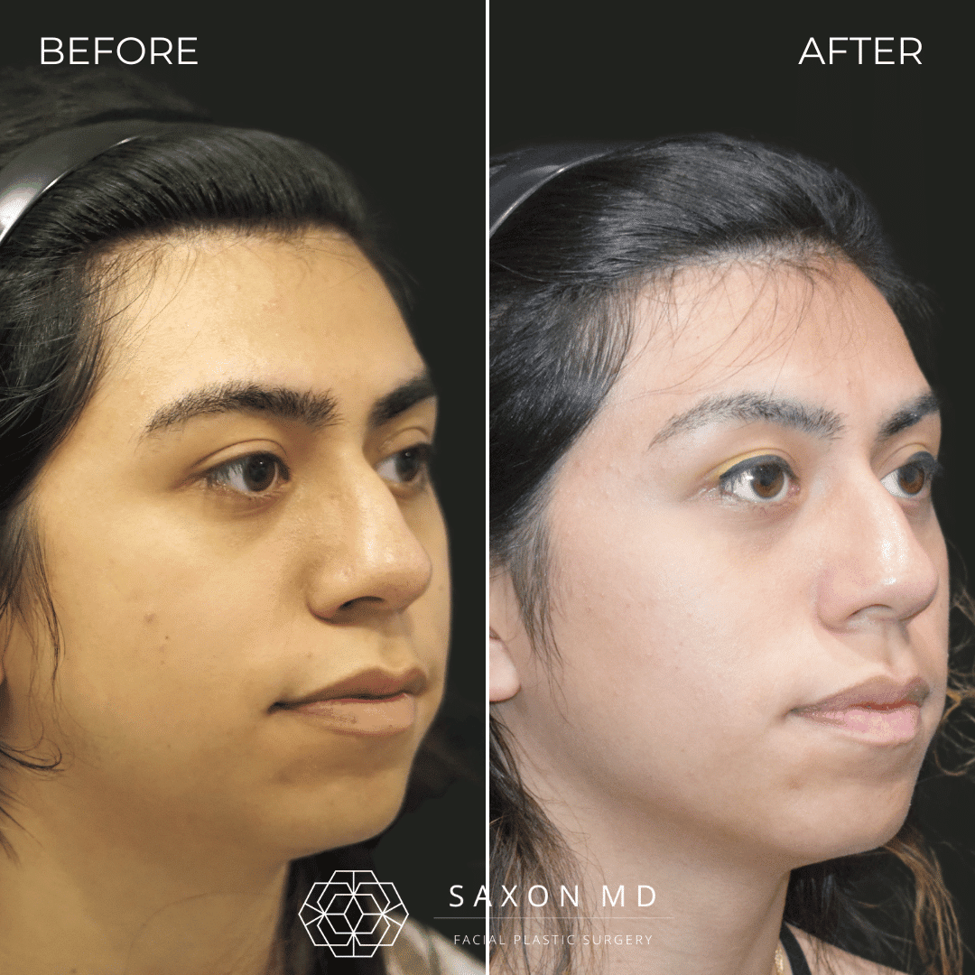 Brow Bone Reduction Before And After | Austin & Dallas, TX