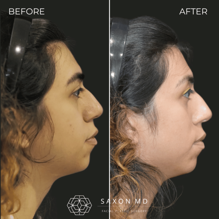 Brow Bone Reduction Before And After | Austin & Dallas, TX
