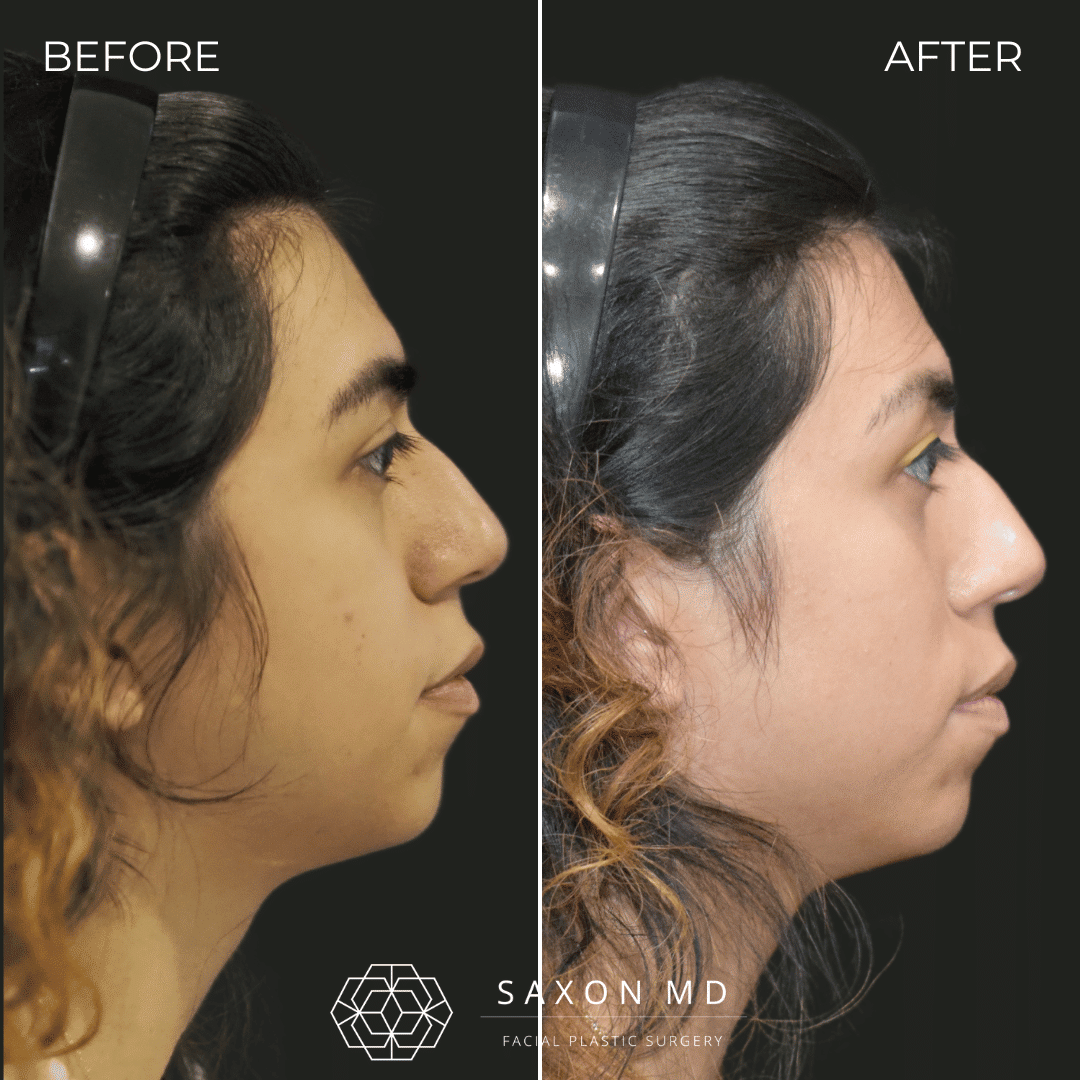 Brow Bone Reduction Before And After | Austin & Dallas, TX