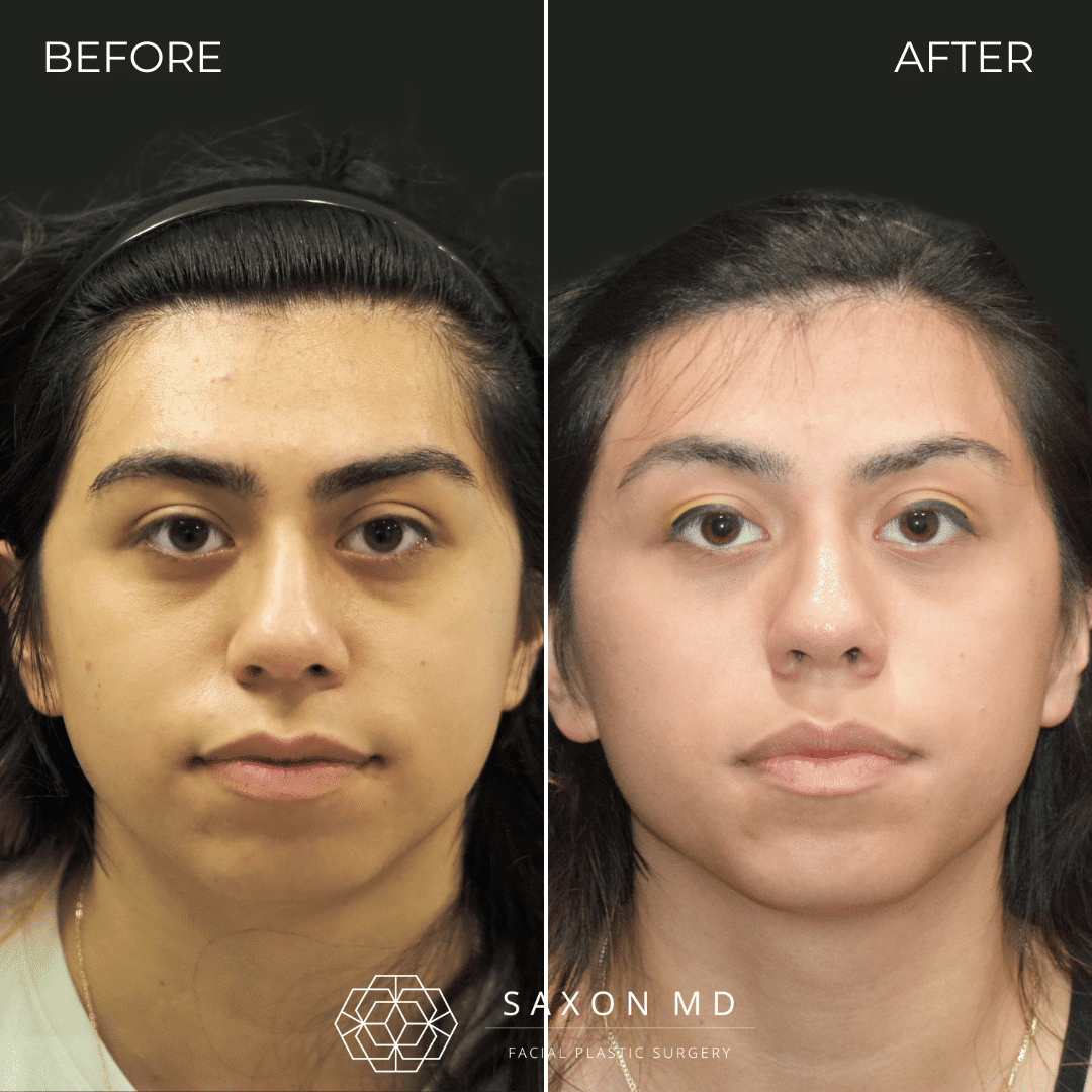 Brow Bone Reduction Before And After | Austin & Dallas, TX