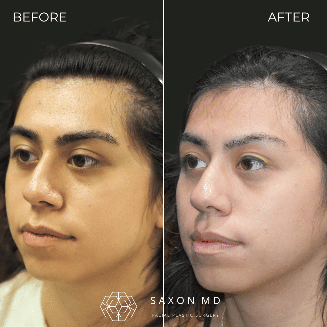 Brow Bone Reduction Before And After | Austin & Dallas, TX