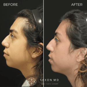 Brow Bone Reduction Before And After | Austin & Dallas, TX