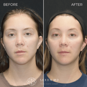 Brow Bone Reduction Before And After | Austin & Dallas, TX