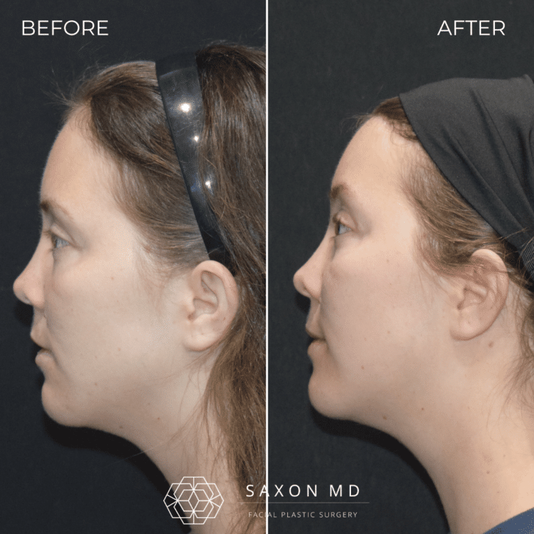 Brow Bone Reduction Before And After | Austin & Dallas, TX