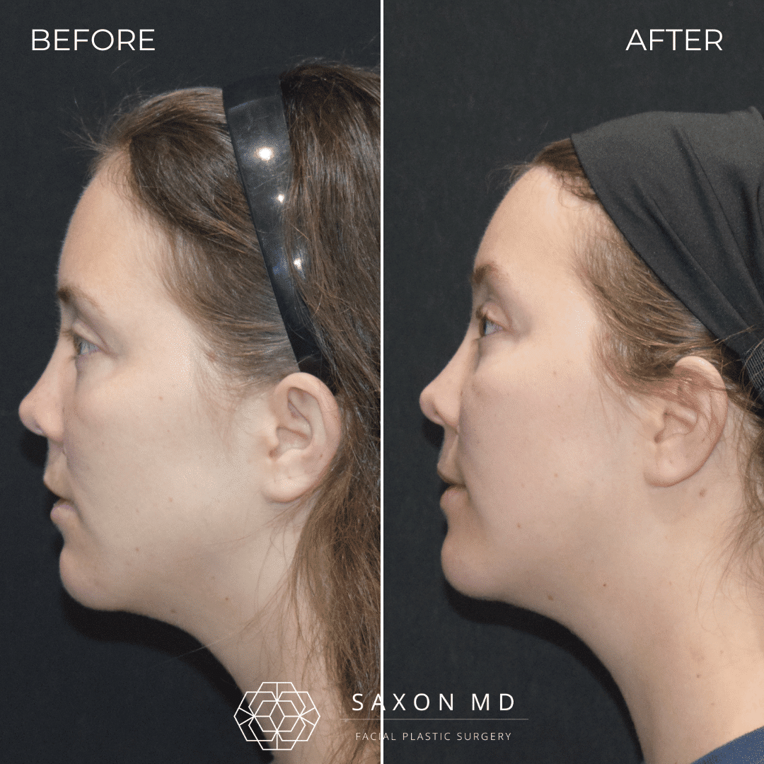 Brow Bone Reduction Before And After | Austin & Dallas, TX