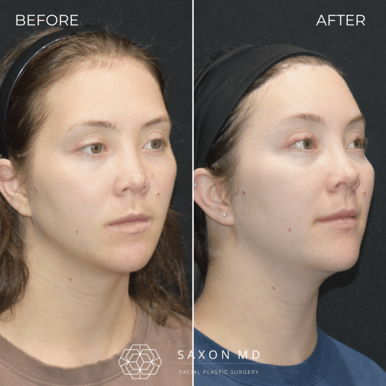 Brow Bone Reduction Before And After | Austin & Dallas, TX