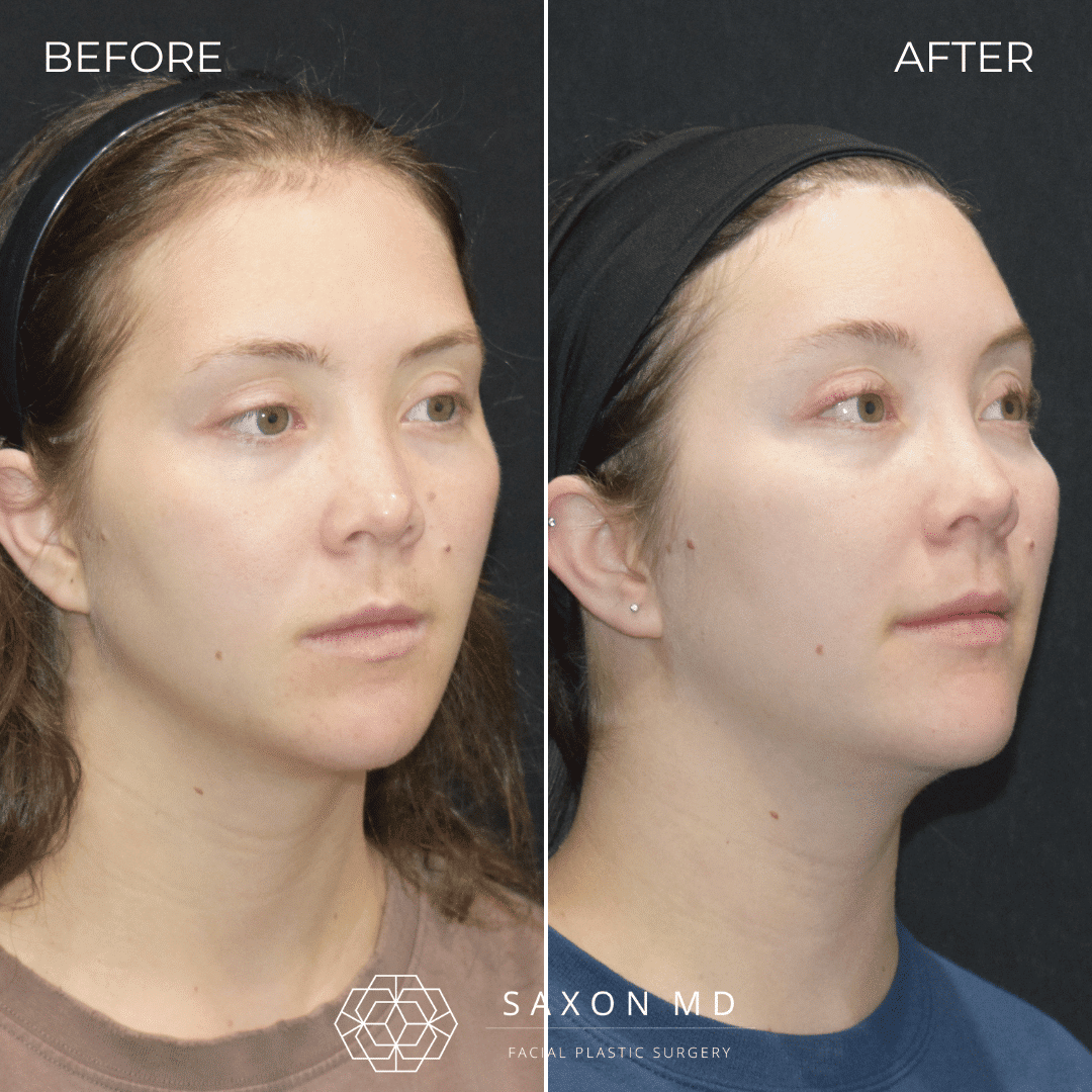 Brow Bone Reduction Before And After | Austin & Dallas, TX