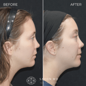 Brow Bone Reduction Before And After | Austin & Dallas, TX