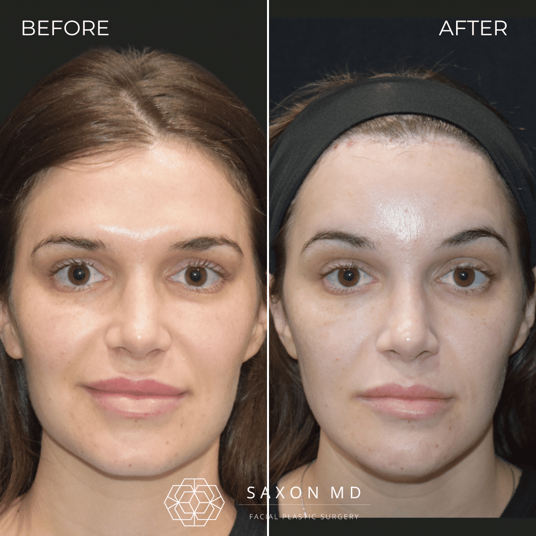 Brow Bone Reduction Before And After | Austin & Dallas, TX