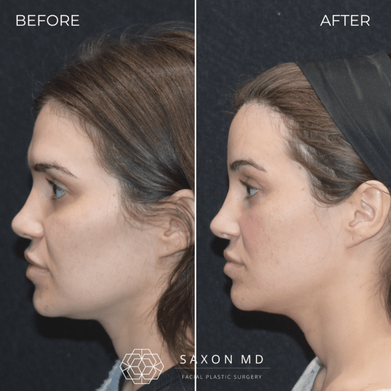 Brow Bone Reduction Before And After | Austin & Dallas, TX
