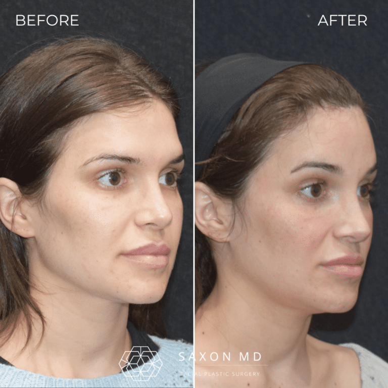 Brow Bone Reduction For Women With Frontal Bossing