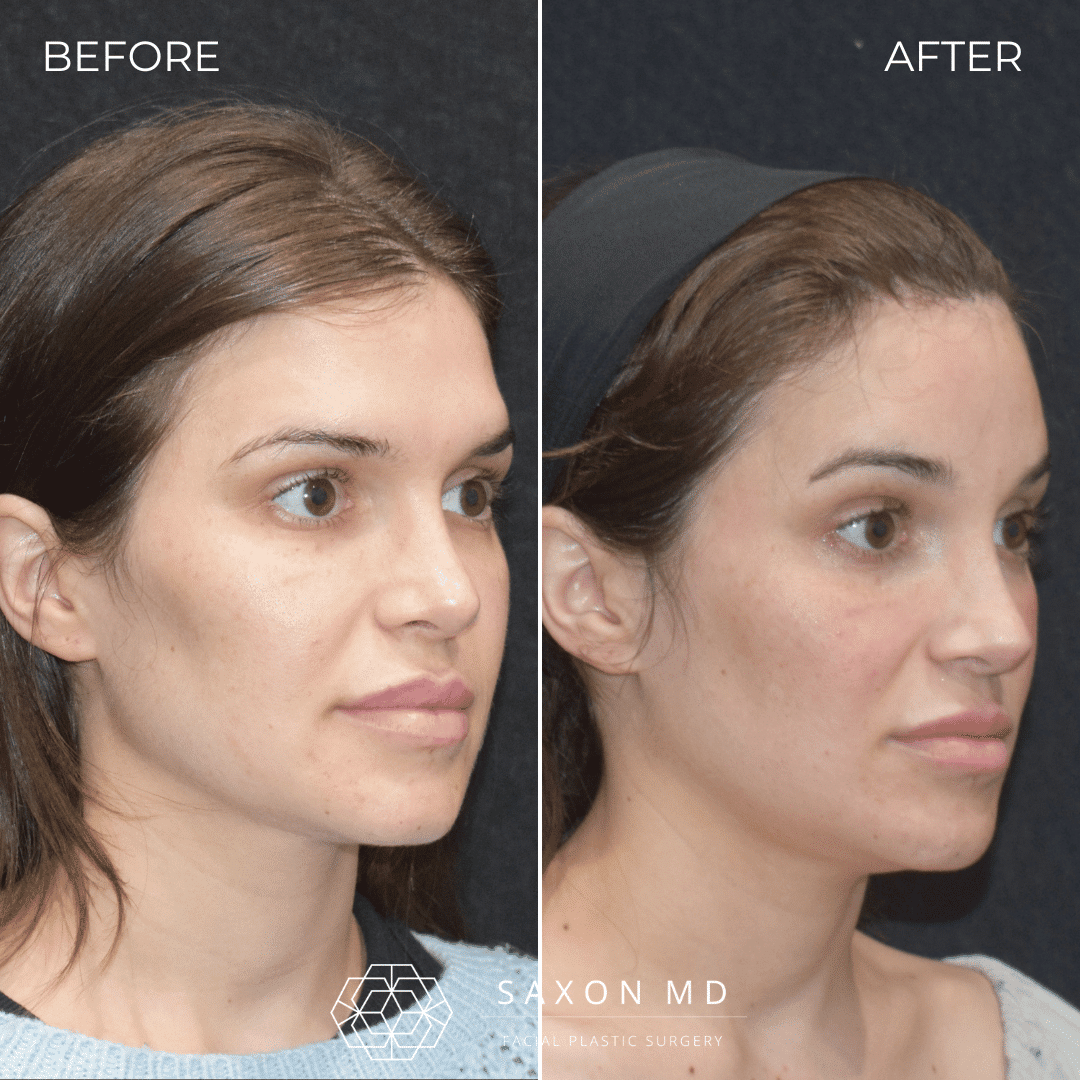 Brow Bone Reduction For Women With Frontal Bossing