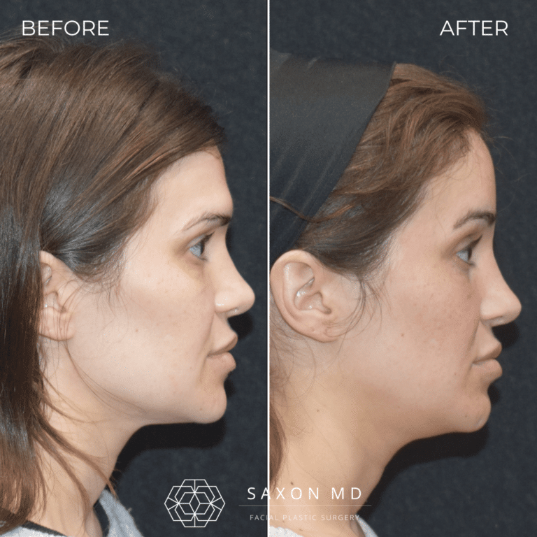 Brow Bone Reduction Before And After | Austin & Dallas, TX