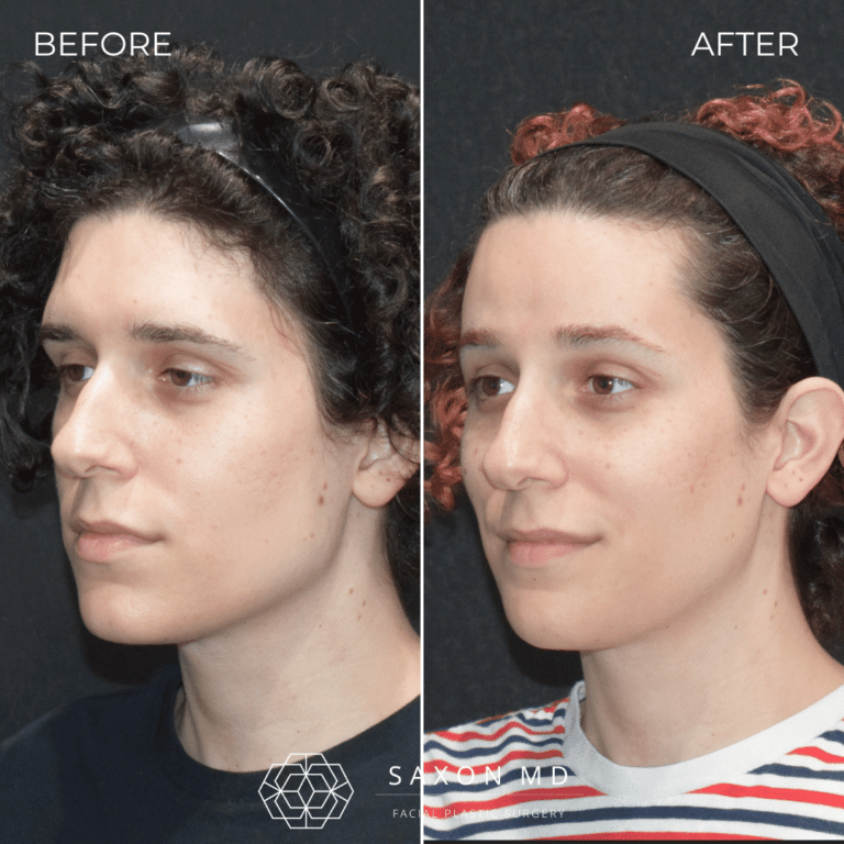 Brow Bone Reduction | Cranioplasty | Austin & Dallas, TX