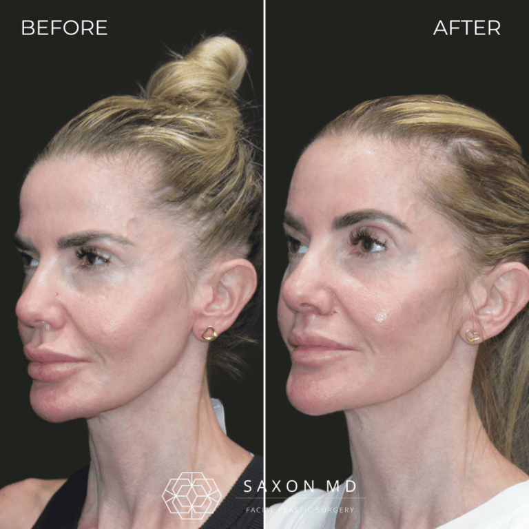 Brow Bone Reduction For Women With Frontal Bossing