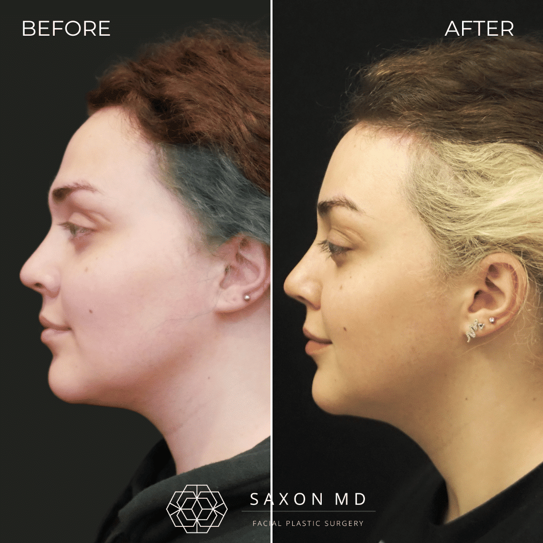 Brow Bone Reduction For Women With Frontal Bossing