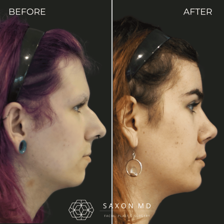 Facial Feminization Surgery Before And After Photos | FFS Austin ...