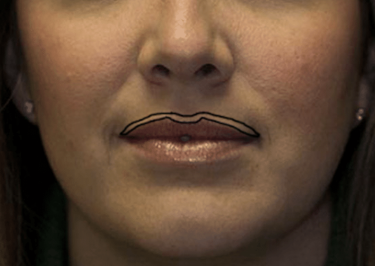 Botched Lip Lift: What Can Go Wrong And How To Avoid It