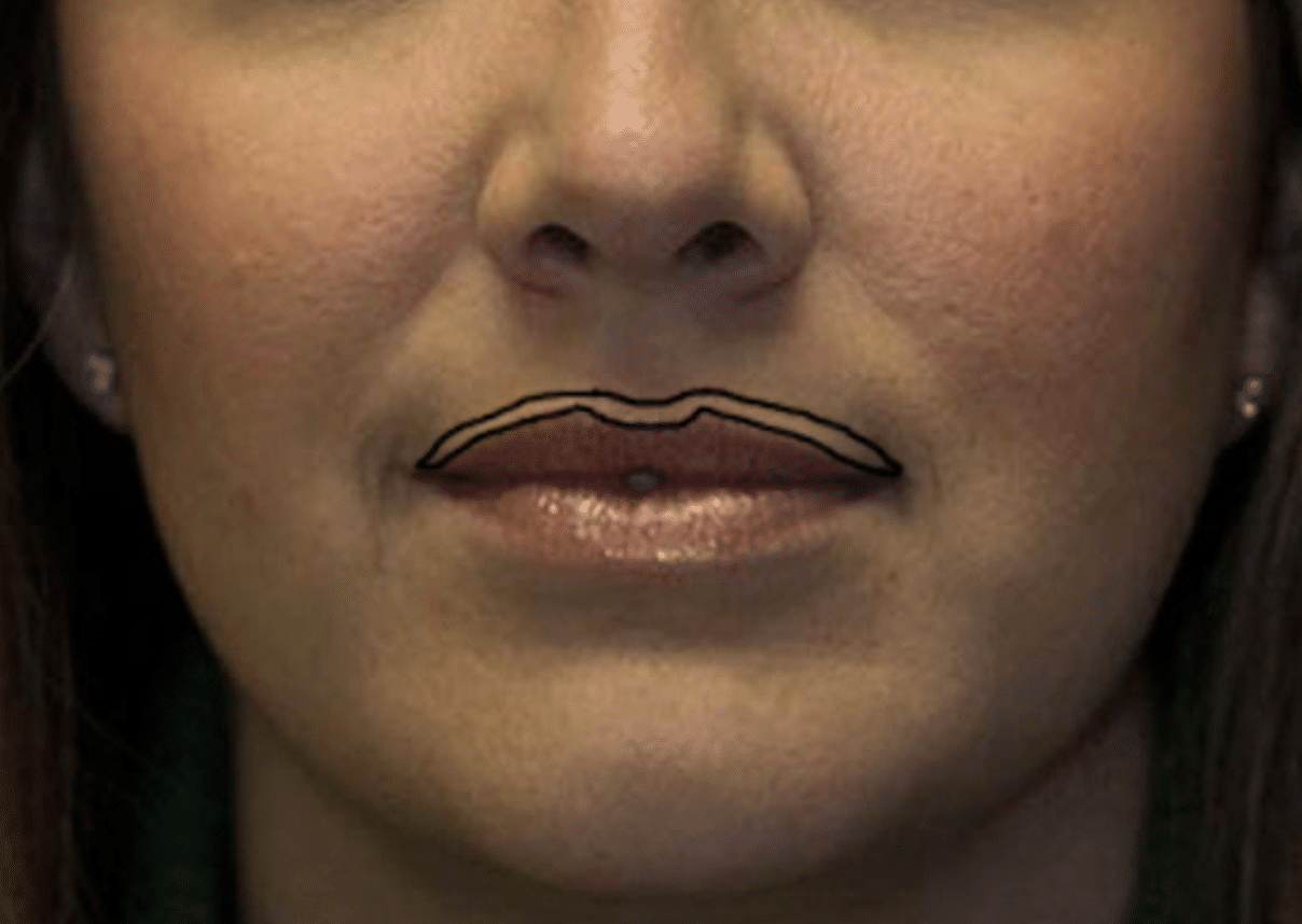 What Are The Different Types Of Lip Lifts? | Saxon MD
