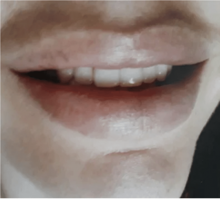 Botched Lip Lift: What Can Go Wrong And How To Avoid It