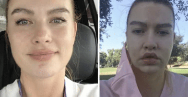 Botched Lip Lift: What Can Go Wrong And How To Avoid It