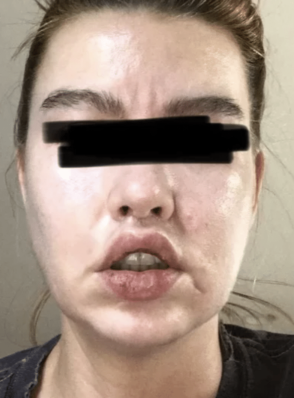 Botched Lip Lift: What Can Go Wrong And How To Avoid It