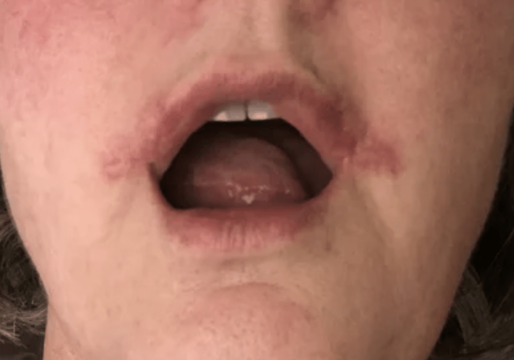 Botched Lip Lift: What Can Go Wrong And How To Avoid It