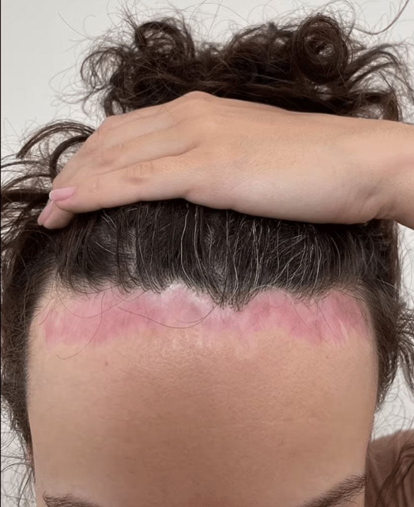 Forehead Reduction Surgery Gone Wrong: Cautionary Tales