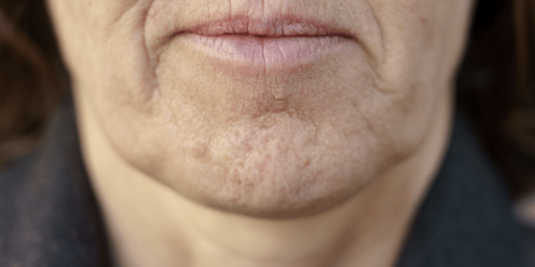 Dimpled Chin: Causes And Treatment Options - Dr. Sarah Saxon